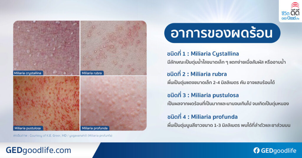 ผดร้อน เกิดจากอะไร รักษาวิธีไหนได้บ้าง? - GED good life ชีวิตดีดี เว็บไซต์เพื่อสุขภาพ ปรึกษา ...